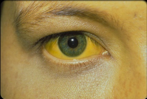 What Your Yellowish Skin Tone is Telling You - Healthdish