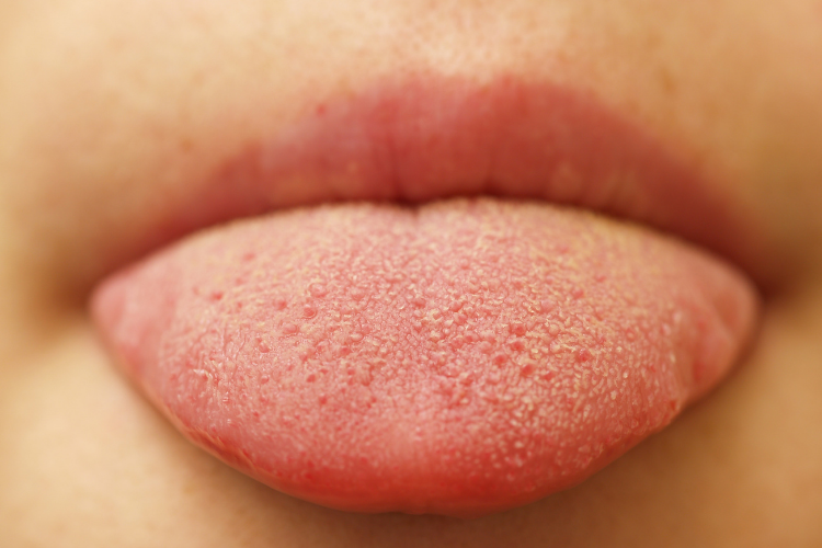 What Your Tongue Is Telling You About Your Health - Healthdish